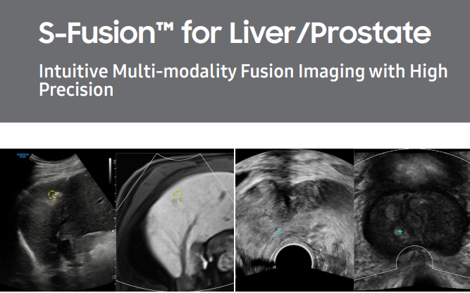 S‑Fusion™ for Liver & Prostate: Advanced Fusion Imaging
